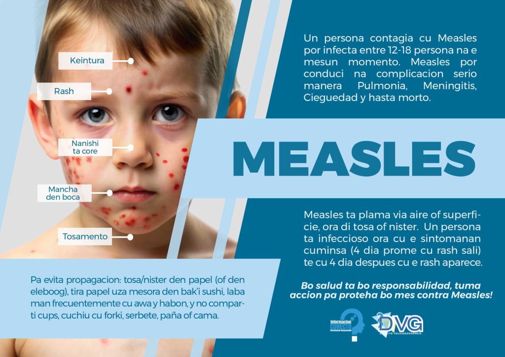 Con Measles (sarampi) ta transmiti su mes – Bon Dia Aruba | Noticia di ...